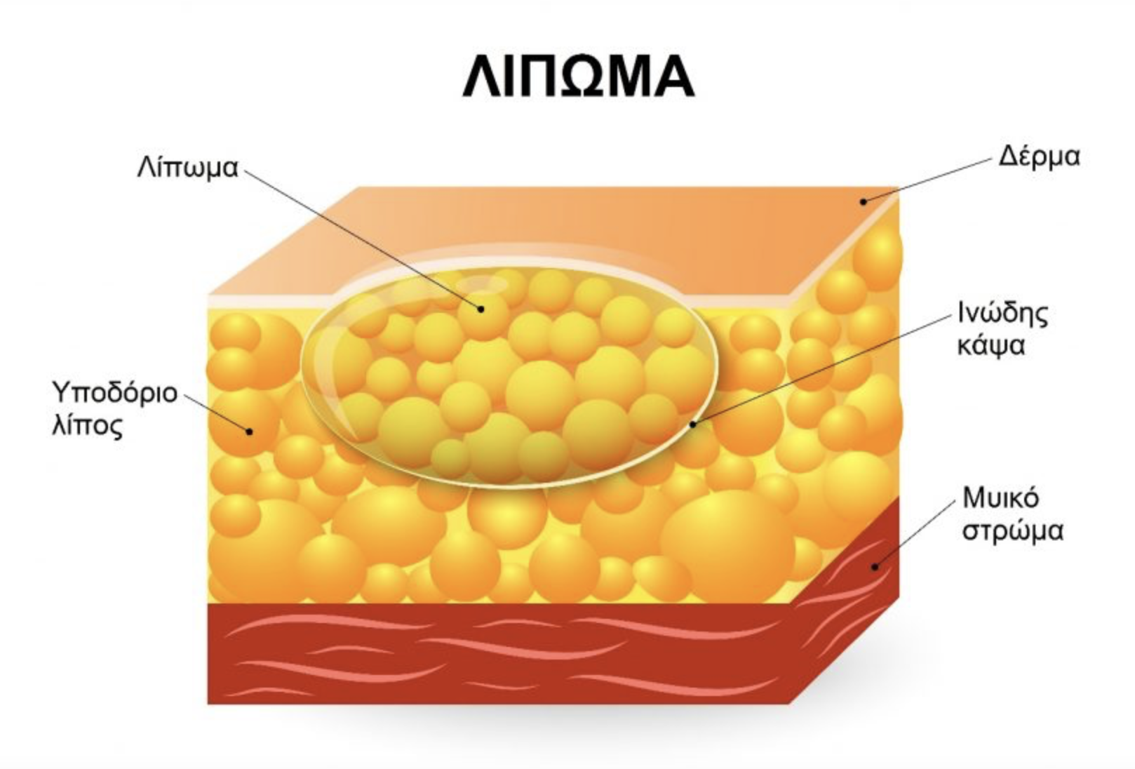 Λίπωμα – Δουκάκης Παραδέλλης MD, PhD